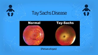 Tay Sachs Disease at emaze Presentation