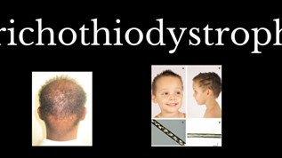 Trichothiodystrophy at emaze Presentation