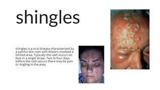 shingles at emaze Presentation