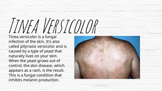 Tinea Versicolor at emaze Presentation