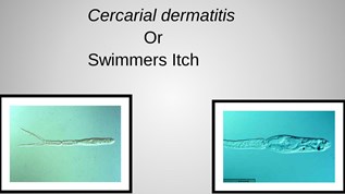 Cercarial dermatitis at emaze Presentation